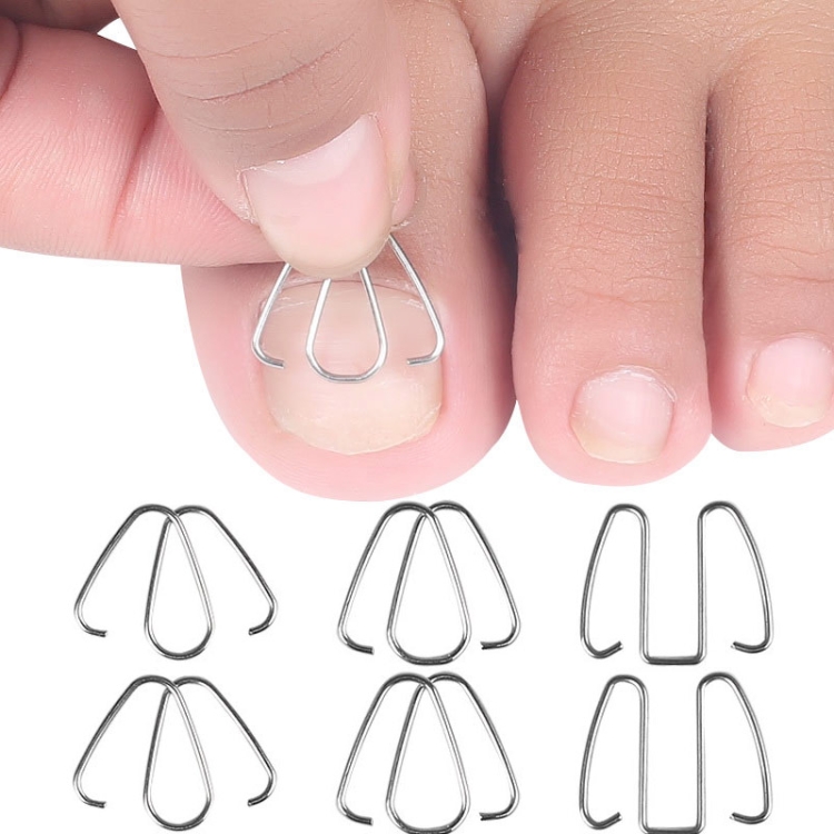 6pcs /Box Ortho Wire Nail Insertion Orthotic Toe Nail Ortho Hooks - Buy ...