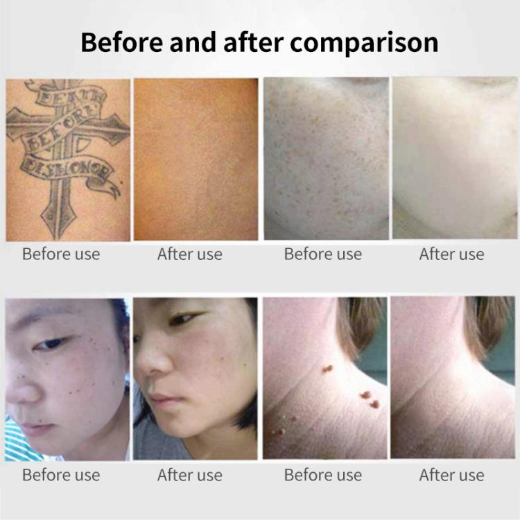 AA-A401 Portable Laser Beauty Instrument Mole Removal Freckle Removal ...